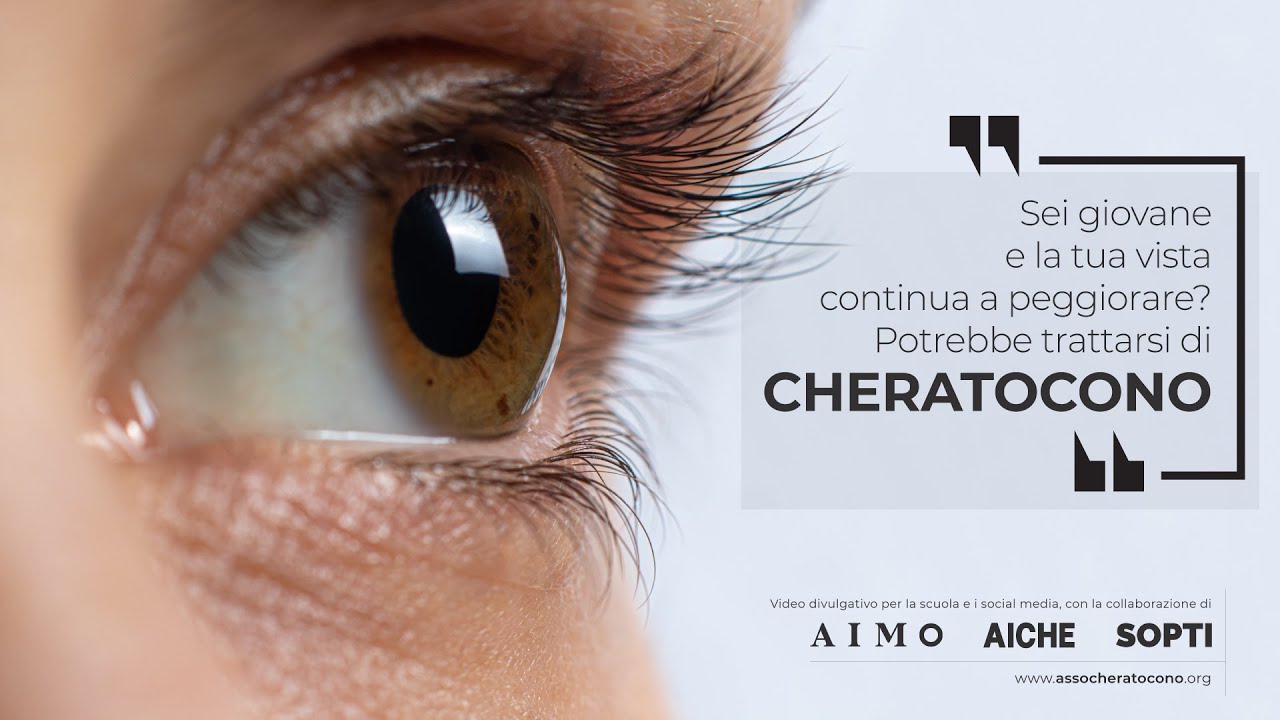 Malattie rare dell'occhio: ecco come riconoscere il cheratocono CLICCA ...